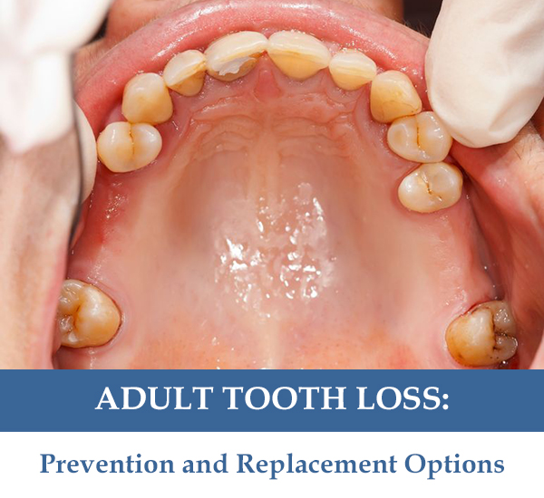 Adult Tooth Loss: Prevention and Replacement Options