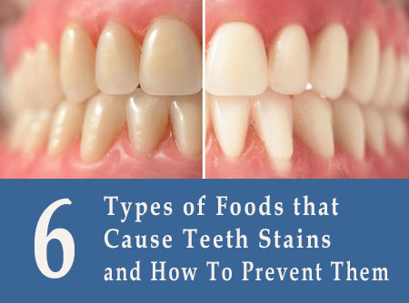 Types of Foods that Cause Teeth Stains and How To Prevent Them