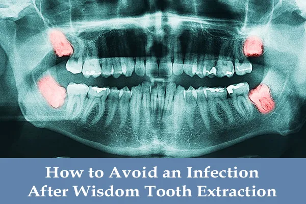How to Avoid an Infection After Having a Tooth Pulled or Wisdom Tooth ...