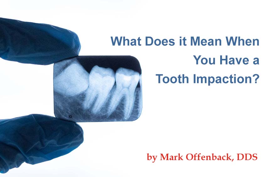 What Does it Mean When You Have a Tooth Impaction?
