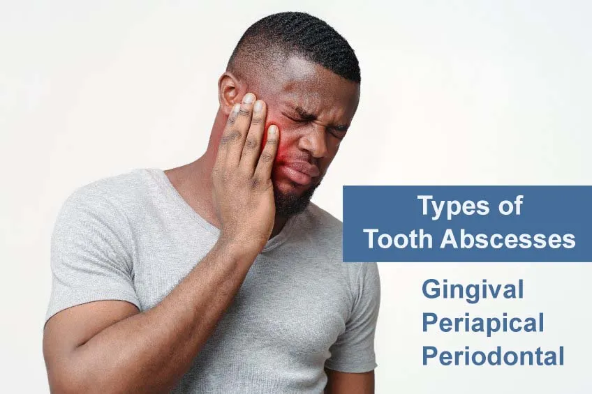 Types of Tooth Abscesses | Gingival | Periapical | Periodontal