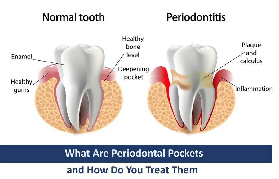 What are Periodontal Pockets and How Do You Treat Them