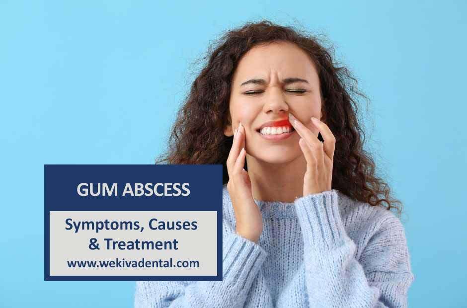Gum Abscess – Symptoms, Causes & Treatment